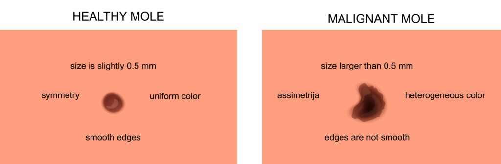 Top 10 Essential Oils and Natural Remedies For Mole Removal | Essential ...