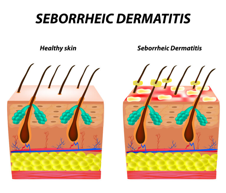 12 Essential Oils for Seborrheic Dermatitis | Essential Oil Benefits