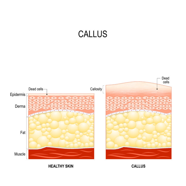 Essential Oils For Calluses: When You’re Tired Of Corns, Blisters, And ...