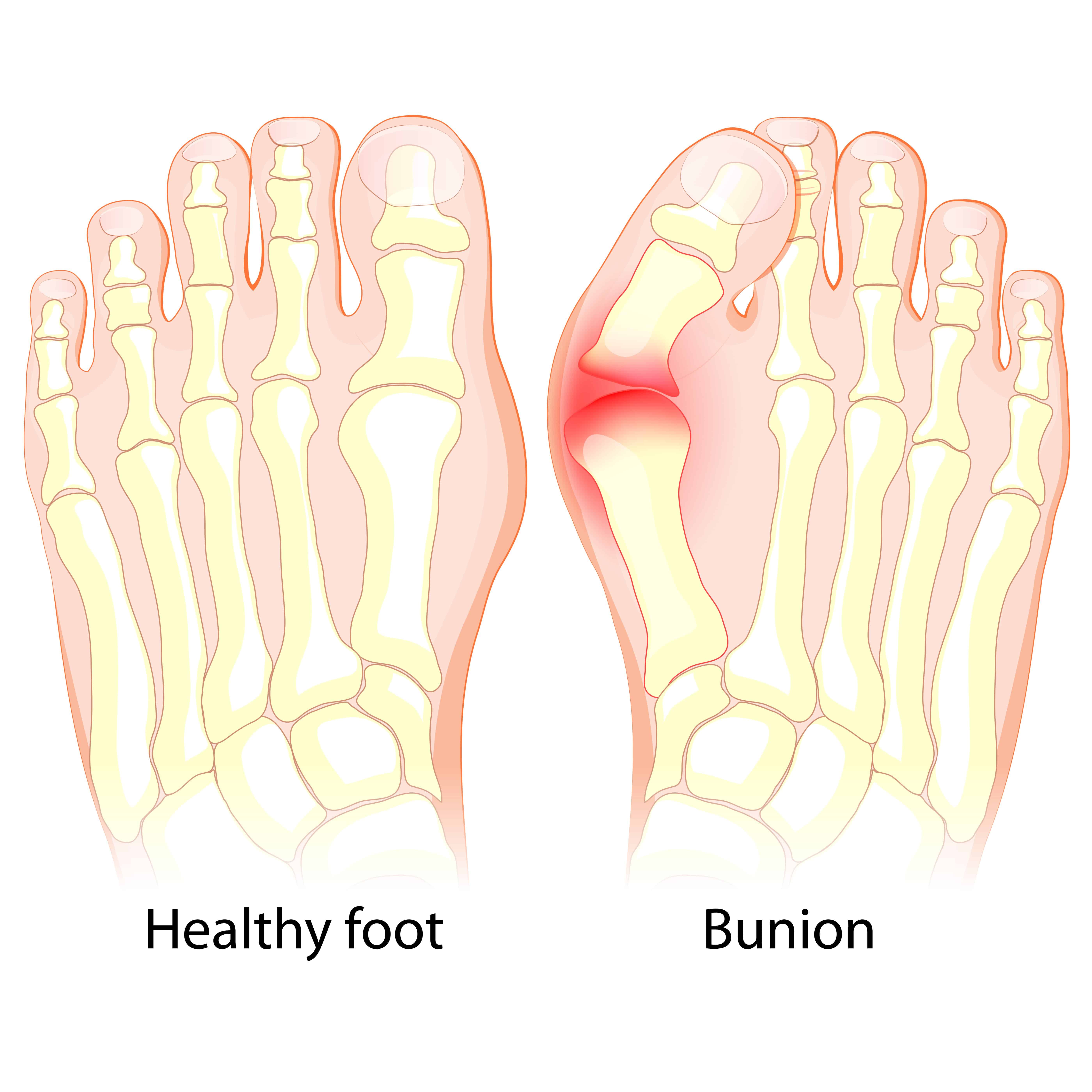 Can Essential Oils Help To Heal Bunions? | Essential Oil Benefits