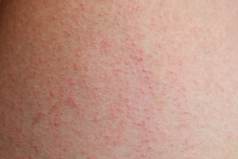 Skin Rashes? Let Essential Oils Handle Those Nasty Eruptions ...